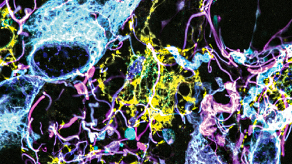 Spotlight: Brain tumors at the nanoscale | MIT - Massachusetts Institute of Technology